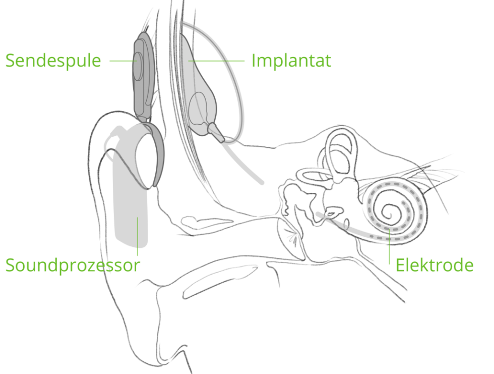 Cochlea-Implantat - einfach dazugehoeren